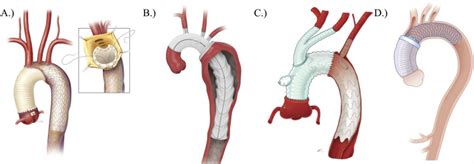 Expert Opinion Where Does The Novel Hybrid Aortic Prosthesis Fit Into