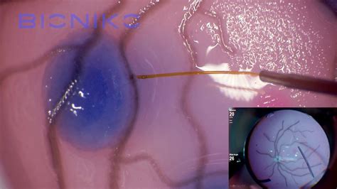 Dayna I On Linkedin Looking To Practice With Subretinal Injection Models At Your Teaching…