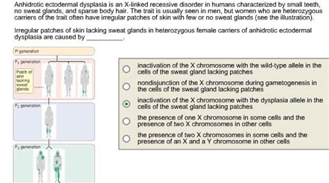 Solved Anhidrotic Ectodermal Dysplasia Is An X Linked