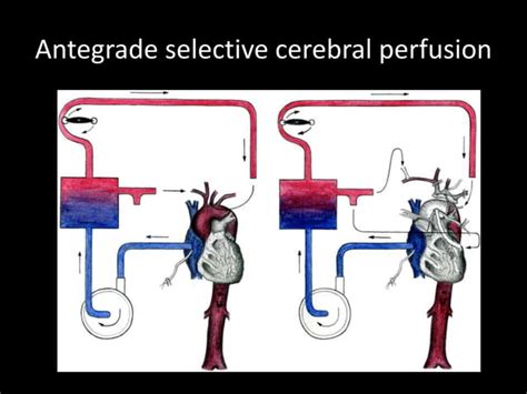 Complex Aortic Arch Surgery Pptx Heart And Cardiovascular Diseases Diseases And Conditions
