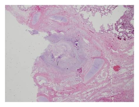 Histopathology 10 Fold Magnification And He Stain Of A Large Bronchus