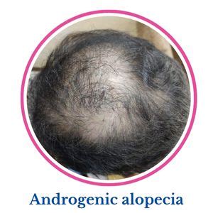 Types Of Alopecia Online Homoeopathic Treatment