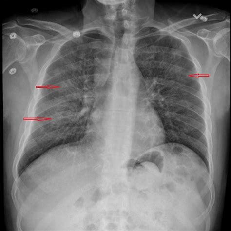 Chest X Ray Demonstrating Mild Diffuse Hazy Opacities Red Arrows Download Scientific Diagram