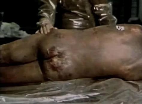 【閲覧注意】チェルノブイリの作業員がどうなったか3枚で分かる画像。ヤバすぎる ポッカキットポッカキット