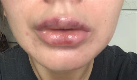 Nsfw Normal Bruising Or Occlusion After Lip Filler R Plasticsurgery