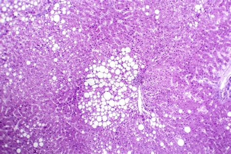 Hepatic Steatosis Light Micrograph Stock Photo Image Of Liver Alcohol 311783318