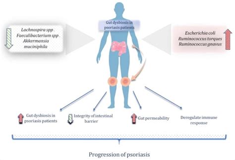 Diana Yedid On Linkedin Psoriatic Gut Microbiome Psoriasis Ruminococcaceae Dysbiosis
