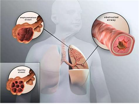 Aetiology And Pathogenesis Of Chronic Obstructive Lung Disease Pptx