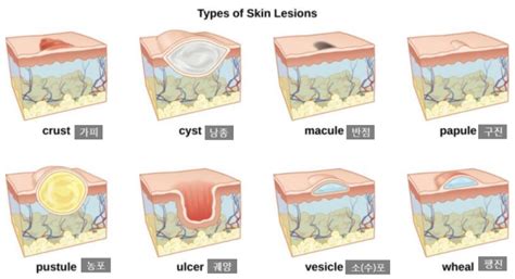 피부 병변 및 발진과 관련된 의학 용어 네이버 블로그