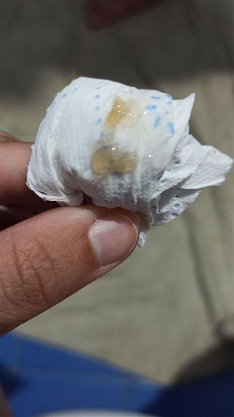 Brown Mucus Discharge