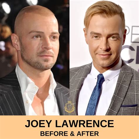 Greffe De Cheveux Joey Lawrence Hair Center Of Turkey