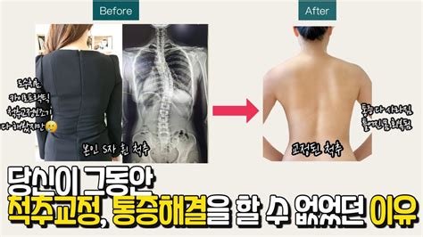 카이로프랙틱 도수치료 마사지 수기치료로 통증해결과 척추교정을 할 수 없었던 이유 틀어진 척추 바로잡고 통증에서 자유로운 몸 되는 근원적인 해결방법 Youtube
