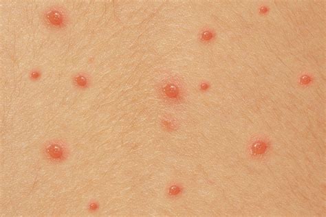 Chickenpox Hseie