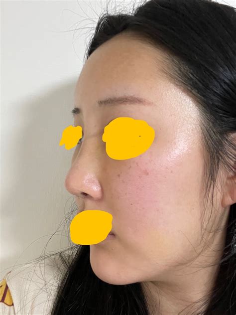 의사에게 물어보세요 27일 코 재수술 강남언니 1등 성형수술and피부시술 정보앱