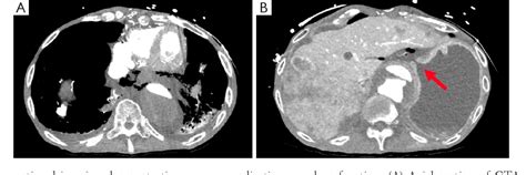 Figure 1 From A Rare Case Of Combined Black Esophagus And Stomach A Case Report Semantic Scholar