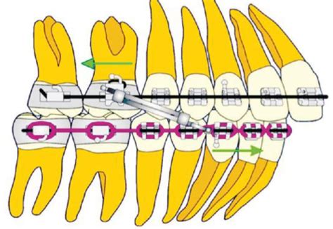 Six Keys To Early Mixed Dentition Class Ii Correction A Quantified Approach To Diagnosis And