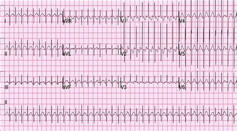 Racing Hearts A Case Of Paediatric Svt — Em3