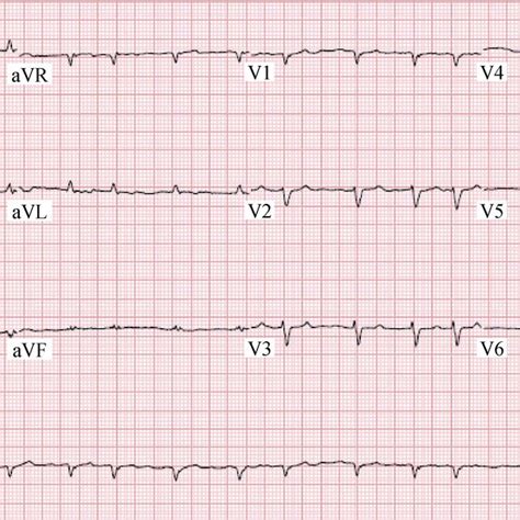 Electrocardiogram Showing Atrial Fibrillation With Rapid Ventricular Download Scientific