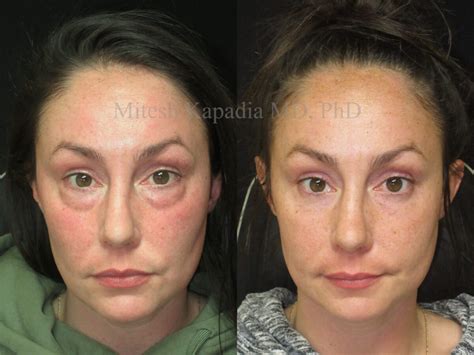 Before And Six Weeks After Lower Blepharoplasty Surgery Boston Eyelid