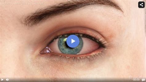 Blepharitis And Chalazion John A Moran Eye Center University Of Utah Health