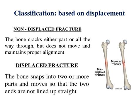 Open Vs Closed Fracture Stserg