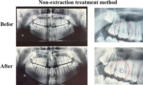 Pulp Stone Formation Following Fixed Orthodontic Treatment A Panoramic