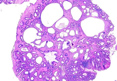 Pathway To Pathology Day 198 Of Md Pathology Angiokeratoma Benign
