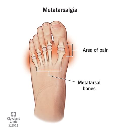 Foot Pain Top Of Foot Near Toes Six Causes Of Big Toe Pain Oakleaf