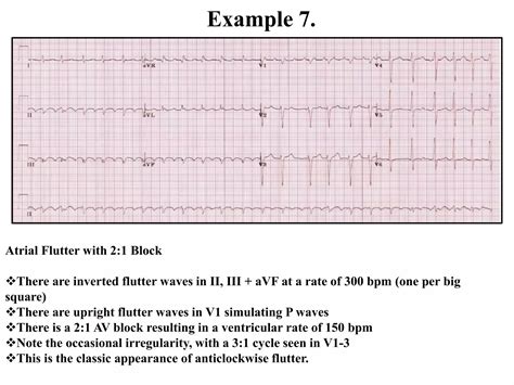 Atrial Fib And Flutter Pptx
