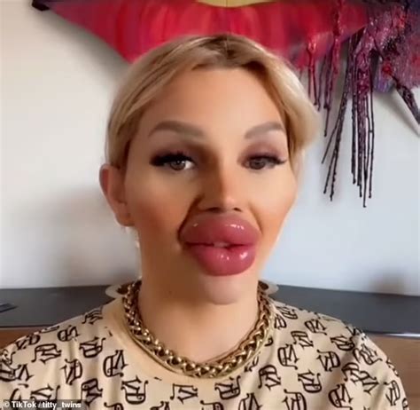 Ive Had So Much Filler Im More Lips Than Human Trolls Say I Look