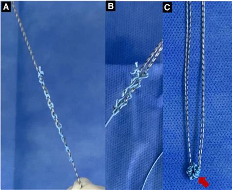 Pictures Demonstrating Anchor A Prepared Anchor B Anchor Looped Download Scientific