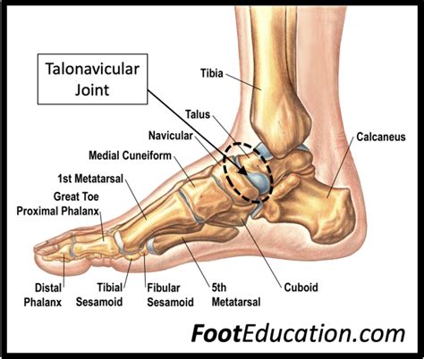 Talonavicular Arthritis Footeducation