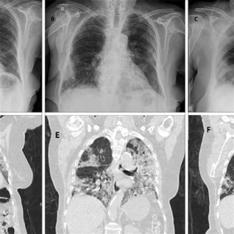 A Mobile Chest Radiograph Day 0 Showing Diffuse Reticular And Linear