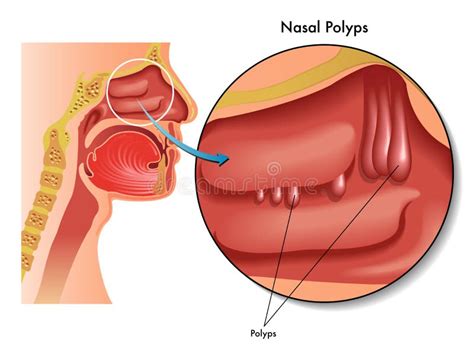 Illustrazione Medica Dei Polipi Nasali Su Fondo Bianco Illustrazione