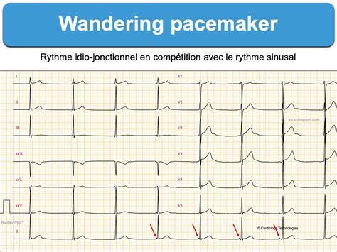 Wandering Pacemaker E Cardiogram