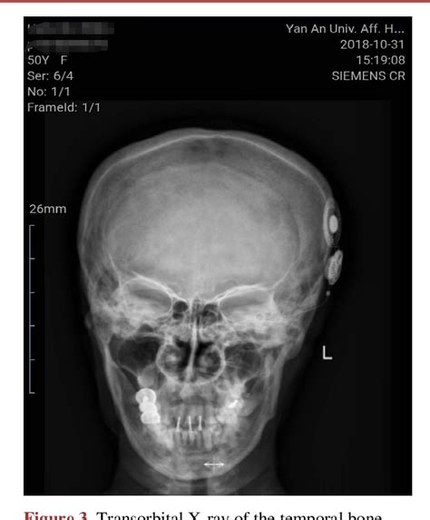 Figure 3 From A Case Of Cochlear Implantation In Chronic Suppurative Otitis Media Was Reported