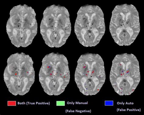 Axial Slices Comparing Automated And Manual Segmentations Download