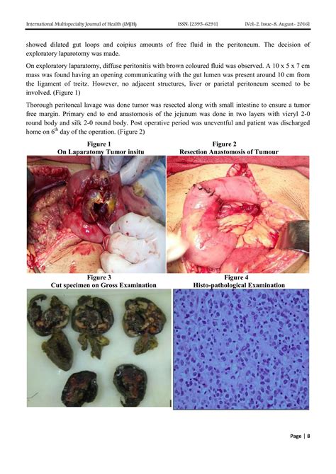 Perforated Jejunal Gastrointestinal Stromal Tumorgist Presenting As