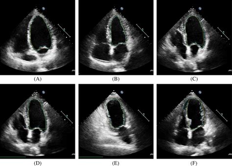 Af Comparison Of Segmentation Contour Generated By The Proposed