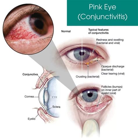 Conjunctivitis Treatment Nyc Pink Eye Specialist Downtown Manhattan