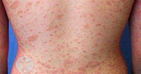 Pityriasis Rosea A Strange Full Body Rash Healdove