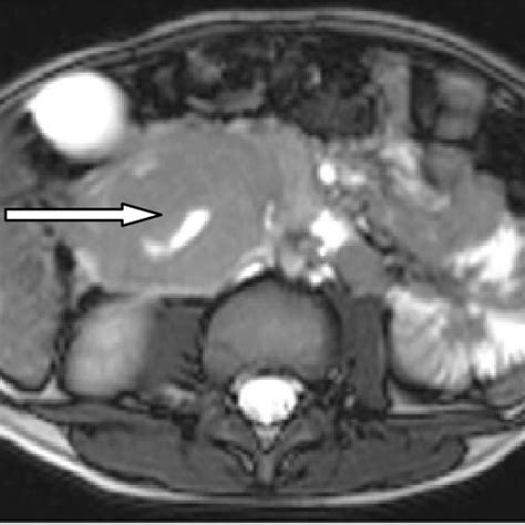 Endoscopic Image Of Polypoidal Mass And Ulcer In Duodenum Download Scientific Diagram