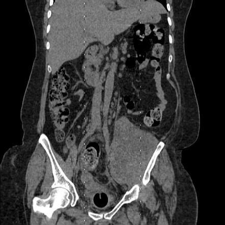 Psoas Abscess Mri