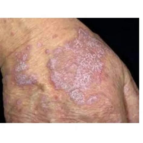 Lichen Planus Treatment In Noida By Homoeopathic World Id 25945514433