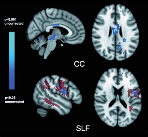 voxelwise correlation analysis between gfa and frsbe scale t scores