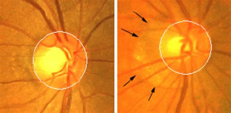 A Outline Of Optic Disc White Ellipse B Outline Of Optic Disc