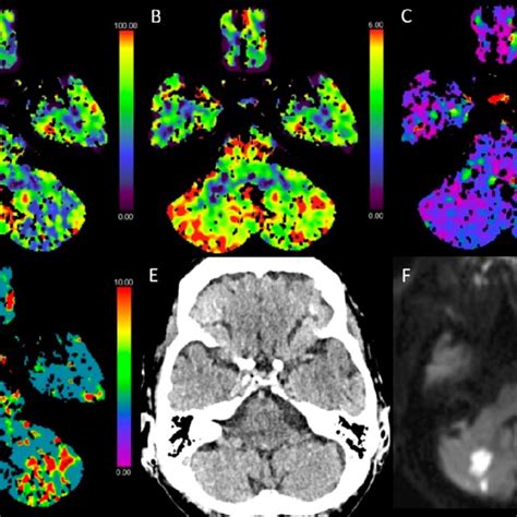 Color Coded Maps Generated From Computed Tomography Perfusion Ctp Of Download Scientific