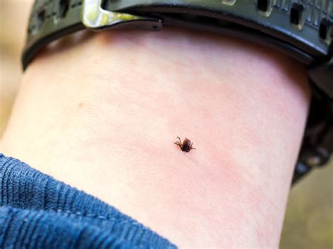 Tick Bites Symptoms Treatments Pictures And Prevention