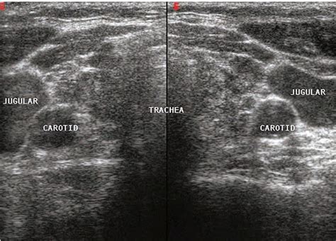 Thyroiditis Radiology