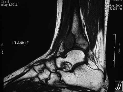 Msk Distal Tibial Cyst 1 Radioogle Msk Distal Tibial Cyst 1 Radioogle